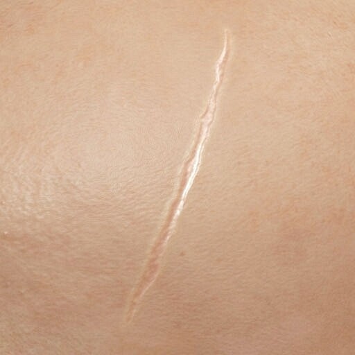 SkinGen: Liquid&Scar