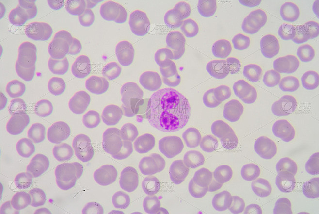 Pelger-Huet异常双叶中性粒细胞